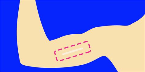 Nexplanon 5 Things To Know About The Birth Control Implant SELF