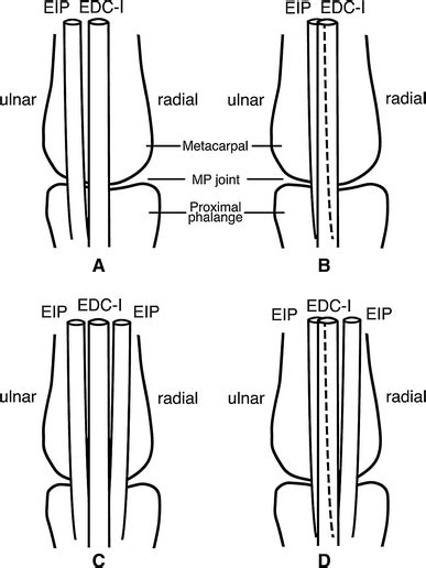 Extensor Indicis Origin And Insertion