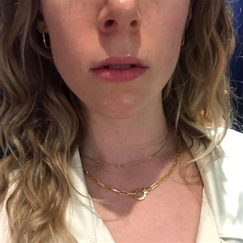 Can You Wear Makeup After Lip Fillers Saubhaya Makeup