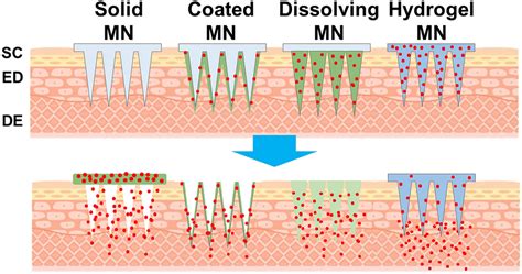 Microneedle For Transdermal Drug Delivery Current Trends And