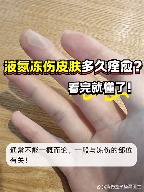 液氮冻伤皮肤多久痊愈？
