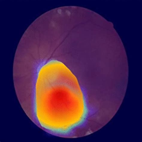 A Sample Pdr Fundus Image B Saliency Map From Resnet50 Model With