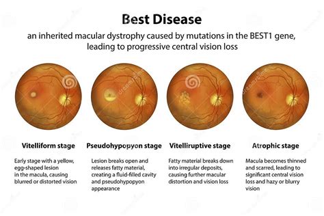 Stages Of Best Vitelliform Macular Dystrophy Illustration Stock