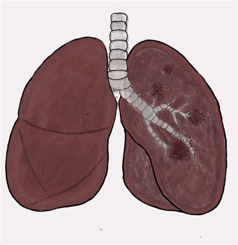 Unhealthy Lung