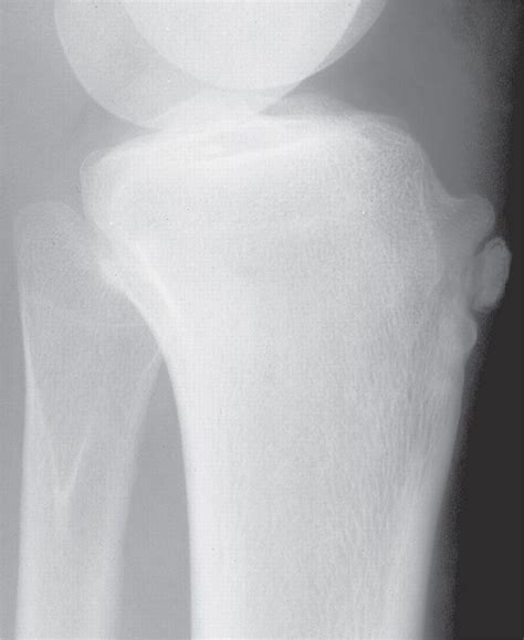 17 Osteonecrosis And Osteochondrosis Musculoskeletal Key
