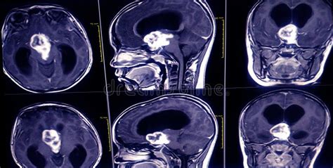 Cerveau Et Orbites Dirm Représentation Da3 5cm La Masse De Masse
