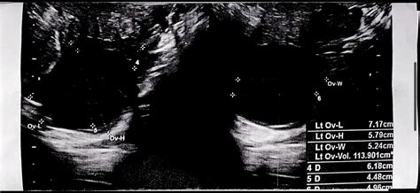 Forbidden Pop I Have A Six Cm Cyst On My Left Ovary And After Some Math It Can Hold Up To 32
