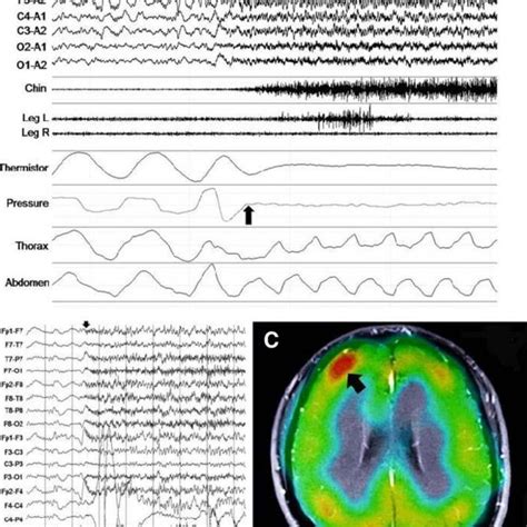Polysomnography EEG And Imaging In A Case Of Epileptic Seizures Download Scientific Diagram