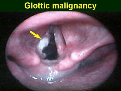 Laryngeal Malignancy Dr Vishal Sharma Overview Most Common