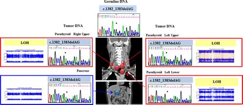 Analysis Of Multiple Endocrine Tumors From The Same Patient Computed Download Scientific