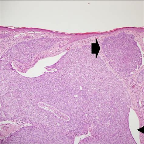 The Nodular Type Of Bcc Is Characterised By Basaloid Cells Showing