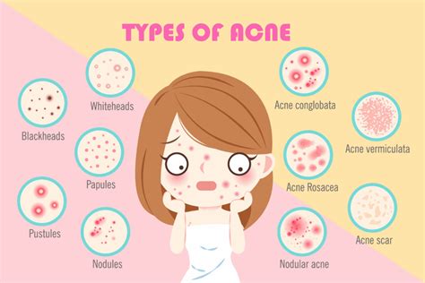 Understanding Acne Conglobata Causes Symptoms X Treatments And More
