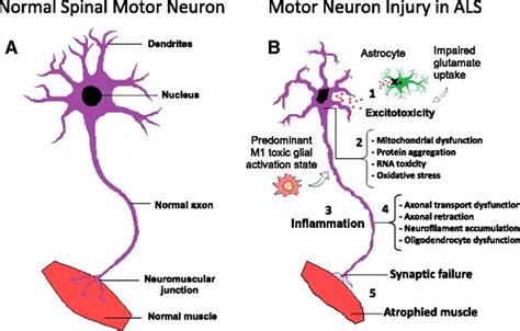 Amyotrophic Lateral Sclerosis Causessymptoms Diagnosis Treatment And Prognosis