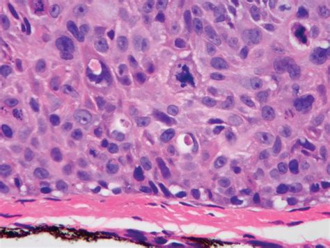 Bowen Disease And Erythroplasia Of Queyrat Concise Medical Knowledge