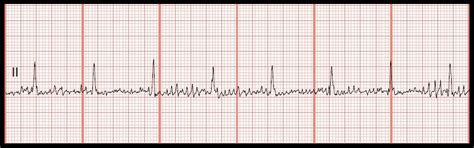 Float Nurse Practice Ekg Rhythm Strips 207
