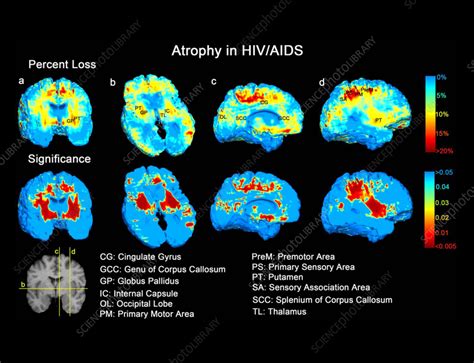 Brain Atrophy In Hiv Aids Mri Scans Stock Image C058 2245 Science Photo Library