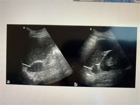 Chapter 13 Abnormal Adrenal Glands Flashcards Quizlet