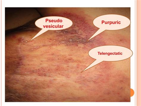 Cutaneous Metastasis Of Breast Cancer Ppt