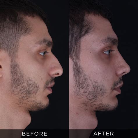 Male Rhinoplasty Before And After Turkey Gallery