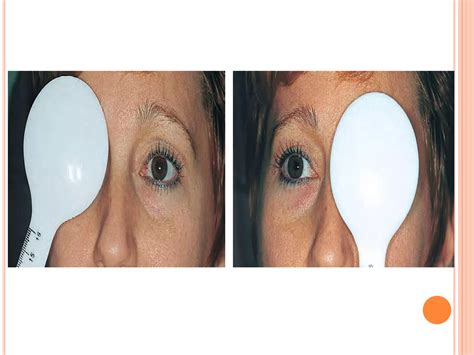 Assessment Of Ocular Alignment Pptx