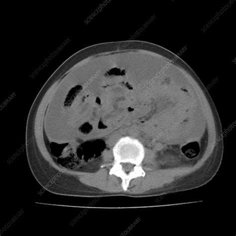Ascites Ct Scan Stock Image F0367436 Science Photo Library