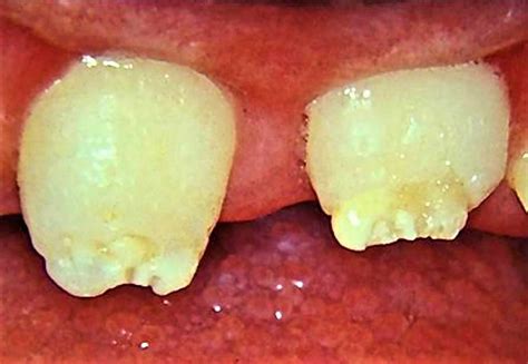 Syphilis Stages Signs Symptoms Diagnosis Treatment And Syphilis Cure