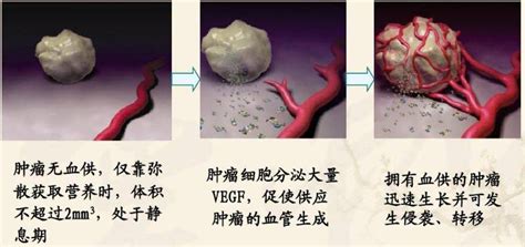 抗血管靶向药不能提高总生存期我还要不要继续使用 觅健