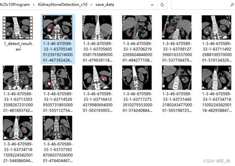 基于yolov10深度学习的ct扫描图像肾结石智能检测系统【python源码pyqt5界面数据集训练代码】深度学习实战、目标检测深度