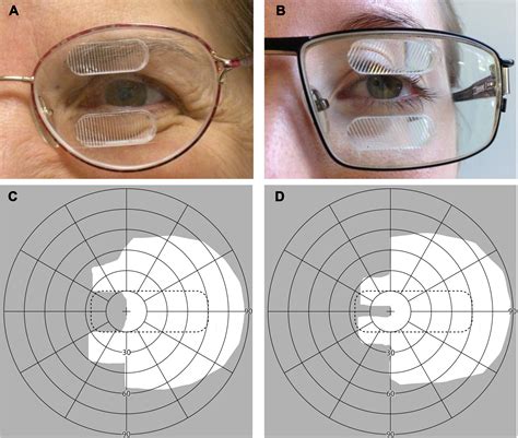 Peripheral Prisms For Visual Field Expansion A Translational Journey Pmc