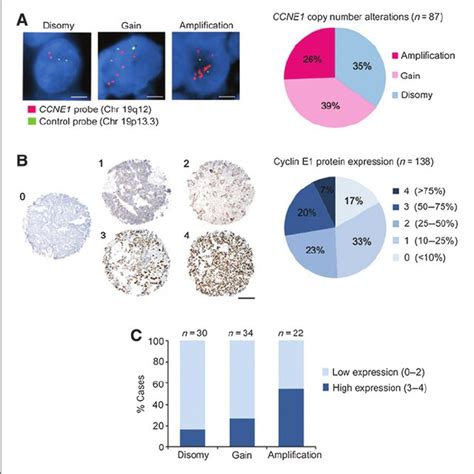 Ccne1 Ampli Fi Cation Is Associated With Increased Cyclin E1 Protein