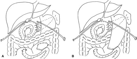 Influence Of The Retrocolic Versus Antecolic Route For Alime Annals Of Surgery
