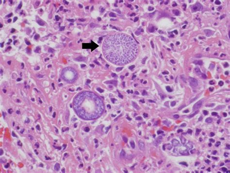 Coccidioidomycosis Market Size Epidemiology Industry Trends And