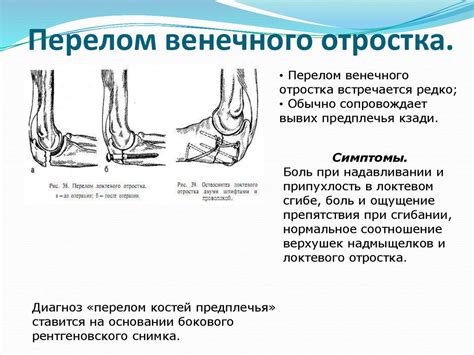 Переломы костей предплечья презентация онлайн
