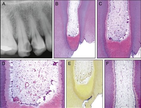 Figure 3 From Correlation Between Clinical And Histologic Pulp Diagnoses Semantic Scholar