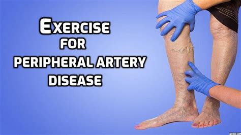 High Intensity Exercise Beneficial For People With Peripheral Artery
