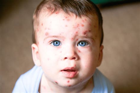 Varicela Contagio Síntomas Y Tratamiento