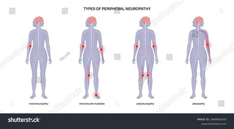 Types Peripheral Neuropathy Mononeuropathy Mononeuritis Multiplex Stock Vector Royalty Free