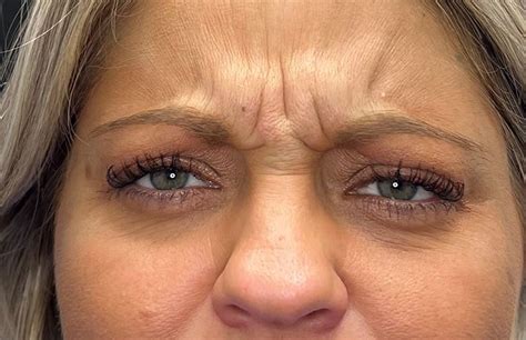 Frown Lines Med Spa Services In Arlington