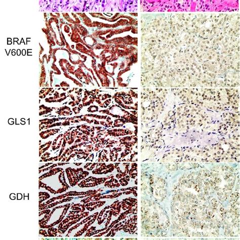 Expression Of Glutamine Metabolism Related Proteins According To The