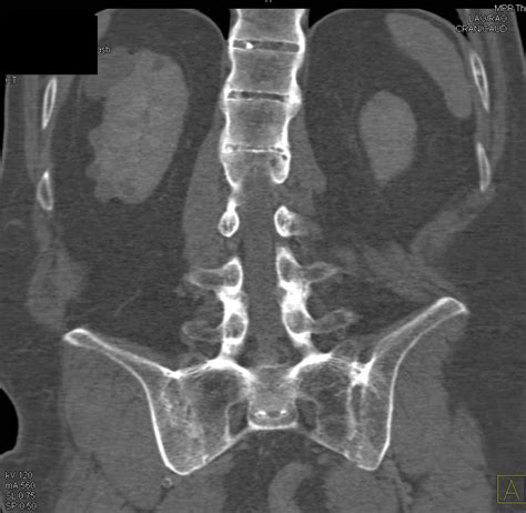 Ankylosing Spondylitis With Sacroiliac Joint Si Joint Fusion