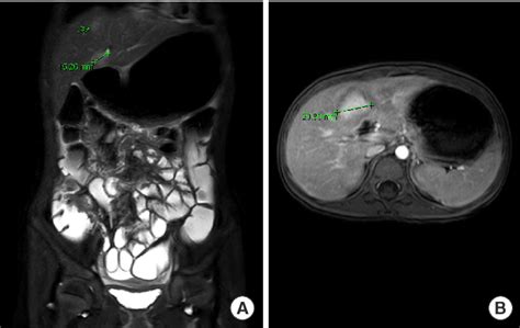 Figure 2 From Pyogenic Liver Abscess As An Extra Intestinal