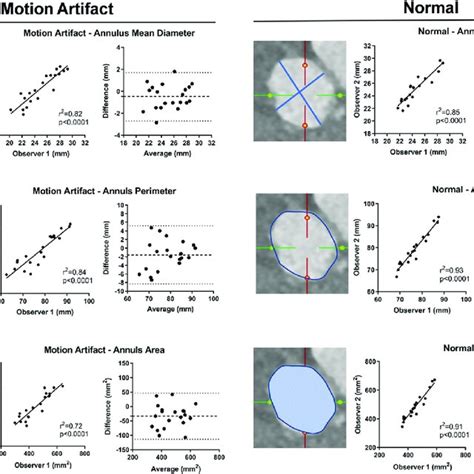 Interobserver Variability Correlation Left And Bland Altman Plots Download Scientific