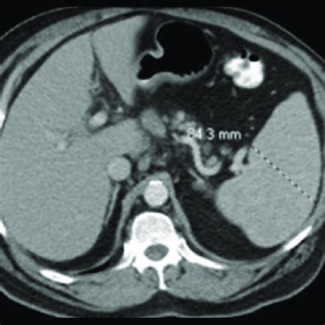 Axial Ct Scan Showing Splenomegaly Of 843 Mm Download Scientific