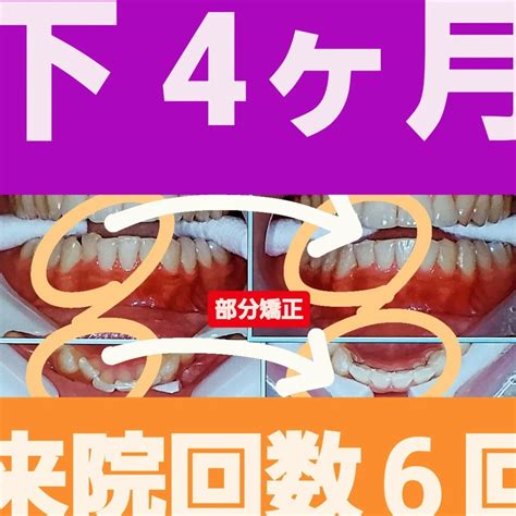 下4ヶ月、来院回数6回 部分矯正 前歯の部分矯正 前歯矯正 歯列矯正 歯並び矯正 歯科矯正 矯正歯科 矯正 矯正女子