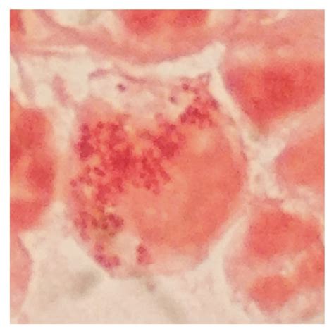 Meningococcal Neonatal Purulent Conjunctivitissepsis And Asymptomatic