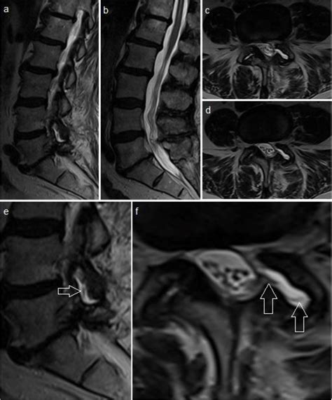 Mri After Decompression Surgery And Sudden Sciatica Onset Sagittal