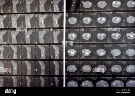 Cairo Egypt October 18 2023 Ct Scan Left Wrist Joint Showing A