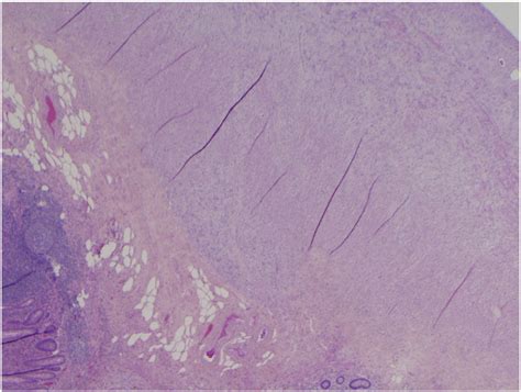 Low Power Showing A Subserosal Nodule At The Tip Of The Appendix Hande