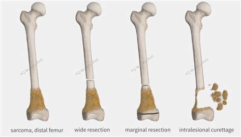 Bone Sarcoma Treatment Wide Resection Surgery Feature Summary The Most Important Part Of The