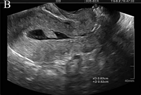 Endometrial Polyp Removal